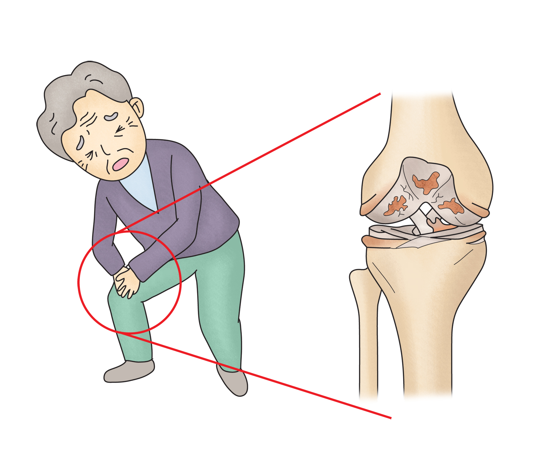 5대 노인성 질환 ⑸퇴행성 관절염의 원인과 증상 및 치료예방수칙feat자가테스트 네이버 블로그