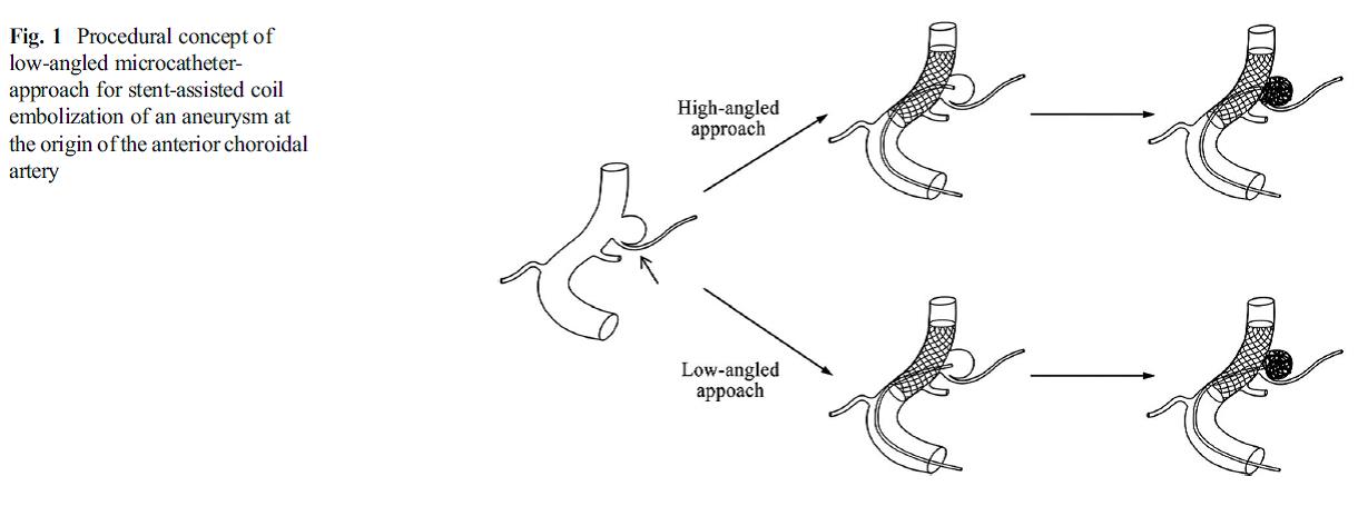 앞맥락동맥 동맥류의 코일 색전술 시 마이크로 카테터의 접근방법 Low Angled Microcatheter Approach