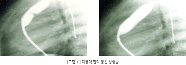 비수술적 치료 선천성심장병 치료 심장질환정보 선천성심장병센터 서울아산병원