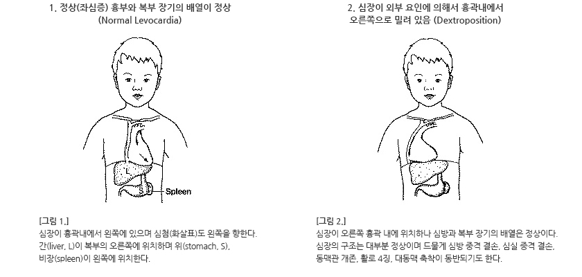 선천성 심장병의 종류 심장의 위치 이상 선천성심장병이란 심장질환정보 선천성심장병센터 서울아산병원