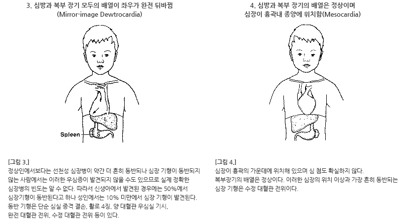 선천성 심장병의 종류 심장의 위치 이상 선천성심장병이란 심장질환정보 선천성심장병센터 서울아산병원