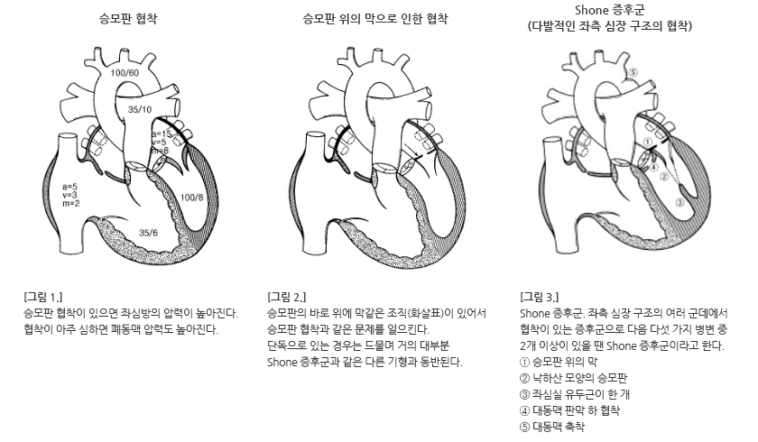 선천성 심장병의 종류 승모판과 기타 좌심실 유입로의 선천성 기형 선천성심장병이란 심장질환정보 선천성심장병센터