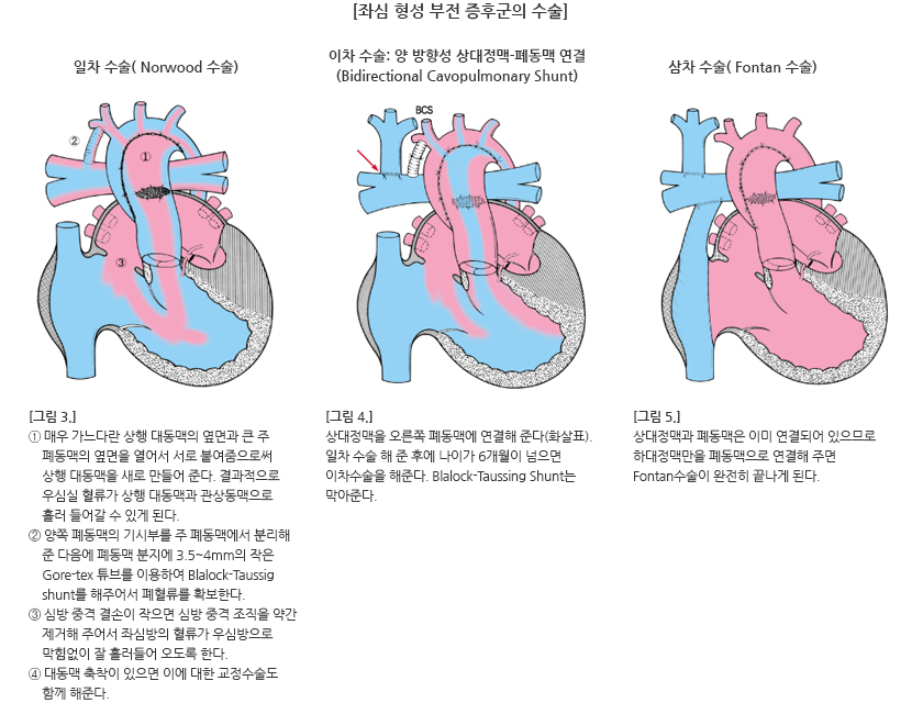 선천성 심장병의 종류 좌심 형성 부전 증후군 선천성심장병이란 심장질환정보 선천성심장병센터 서울아산병원