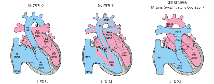 선천성 심장병의 종류 완전 대활관 전위 선천성심장병이란 심장질환정보 선천성심장병센터 서울아산병원