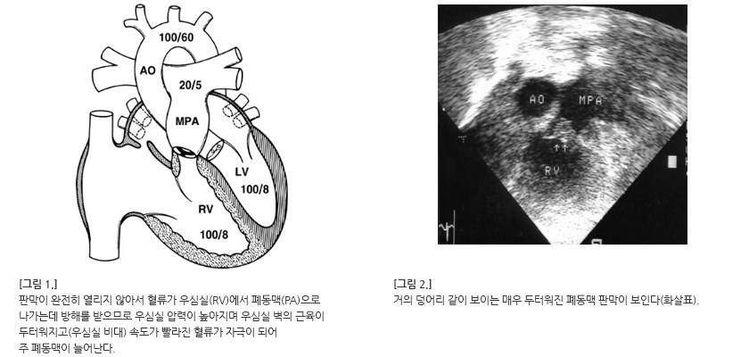선천성 심장병원 종류 폐동맥 협착 선천성심장병이란 심장질환정보 선천성심장병센터 서울아산병원