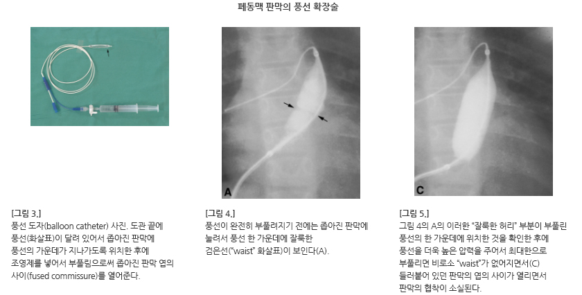 선천성 심장병원 종류 폐동맥 협착 선천성심장병이란 심장질환정보 선천성심장병센터 서울아산병원