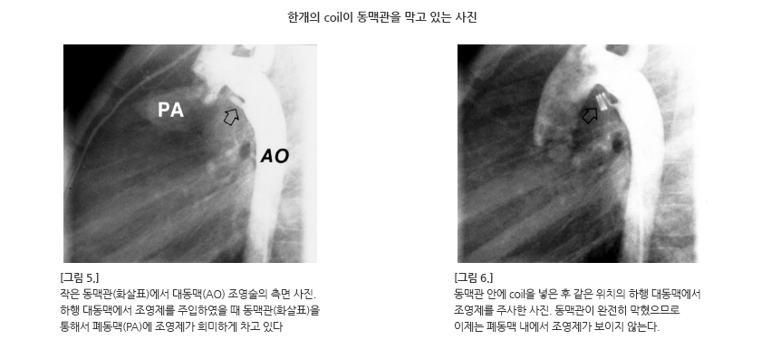 선천성 심장병의 종류 동맥관 개존 선천성심장병이란 심장질환정보 선천성심장병센터 서울아산병원