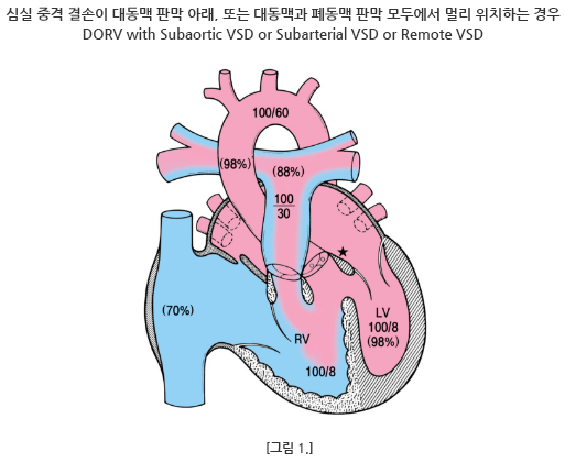선천성 심장병의 종류 양 대혈관 우심실 기시 선천성심장병이란 심장질환정보 선천성심장병센터 서울아산병원