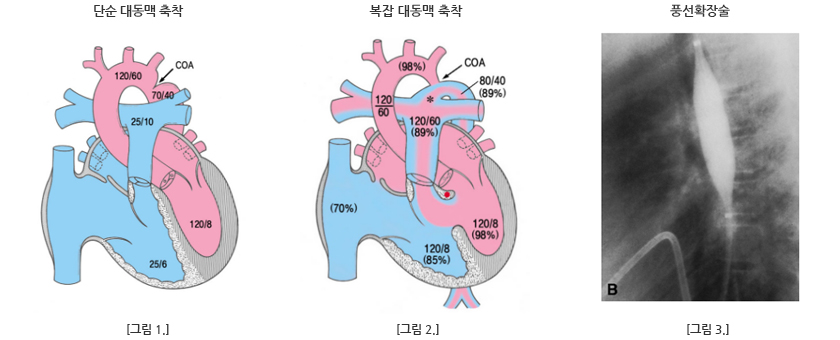 선천성 심장병의 종류 대동맥 축착 선천성심장병이란 심장질환정보 선천성심장병센터 서울아산병원