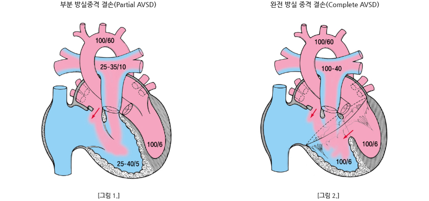선천성 심장병의 종류 방실 중격 결손 선천성심장병이란 심장질환정보 선천성심장병센터 서울아산병원