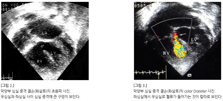 선천성 심장병의 종류 심실 중격 결손 선천성심장병이란 심장질환정보 선천성심장병센터 서울아산병원