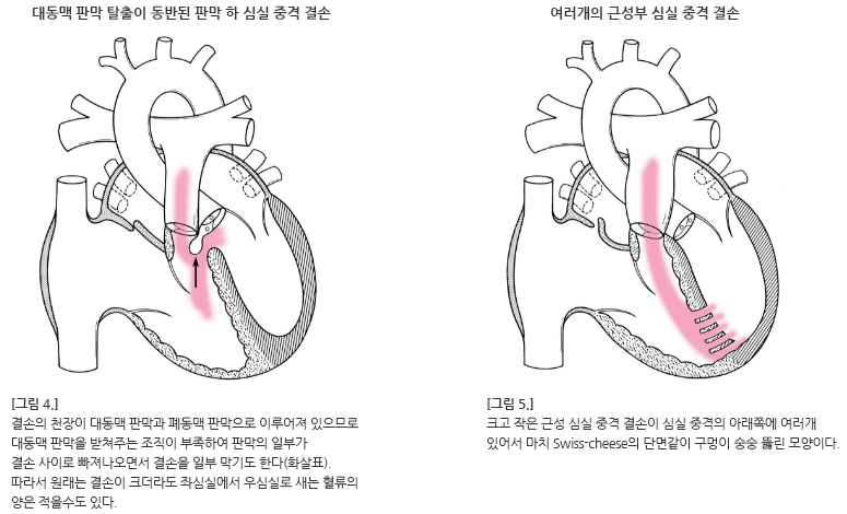 선천성 심장병의 종류 심실 중격 결손 선천성심장병이란 심장질환정보 선천성심장병센터 서울아산병원