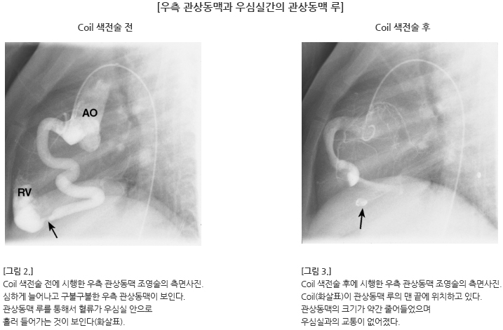 선천성 심장병의 종류 선천성 관상동맥 기형 선천성심장병이란 심장질환정보 선천성심장병센터 서울아산병원
