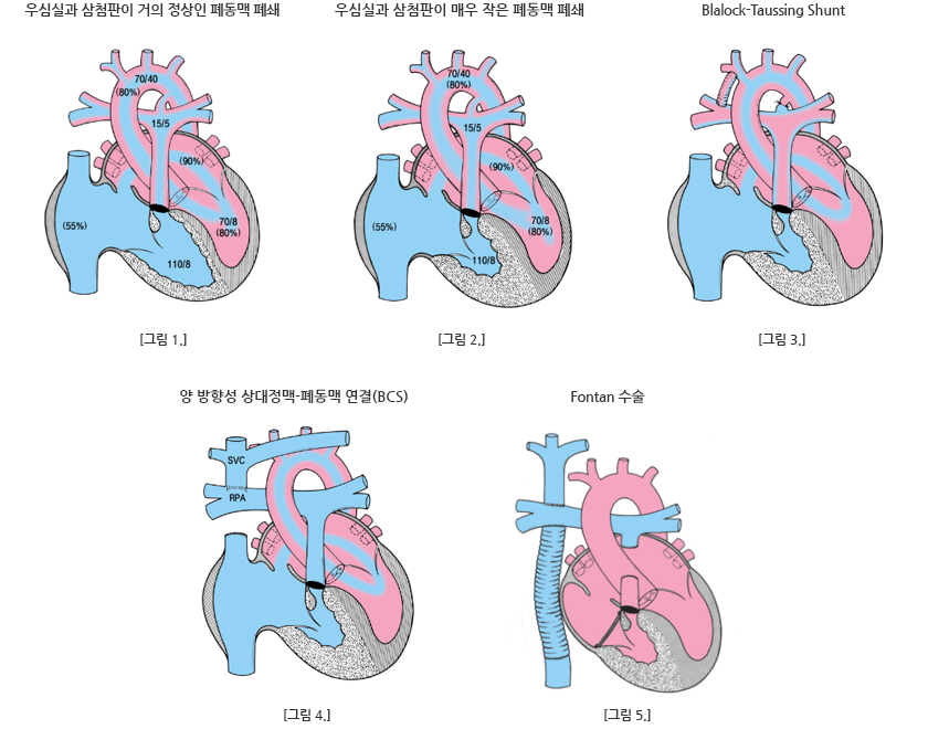 선천성 심장병의 종류 폐동맥 폐쇄 선천성심장병이란 심장질환정보 선천성심장병센터 서울아산병원