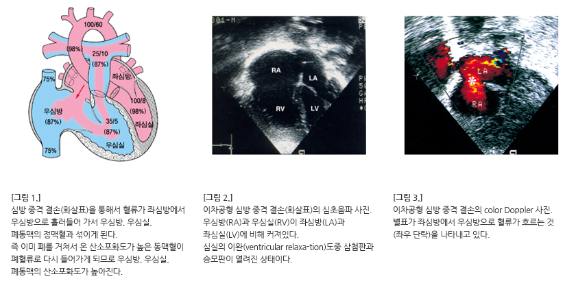 선천성 심장병의 종류 심방 중격 결손 선천성심장병이란 심장질환정보 선천성심장병센터 서울아산병원