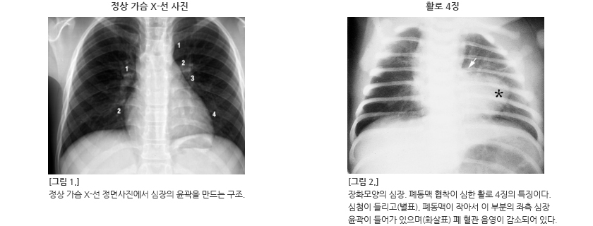 심장검사 선천성심장병이란 심장질환정보 선천성심장병센터 서울아산병원