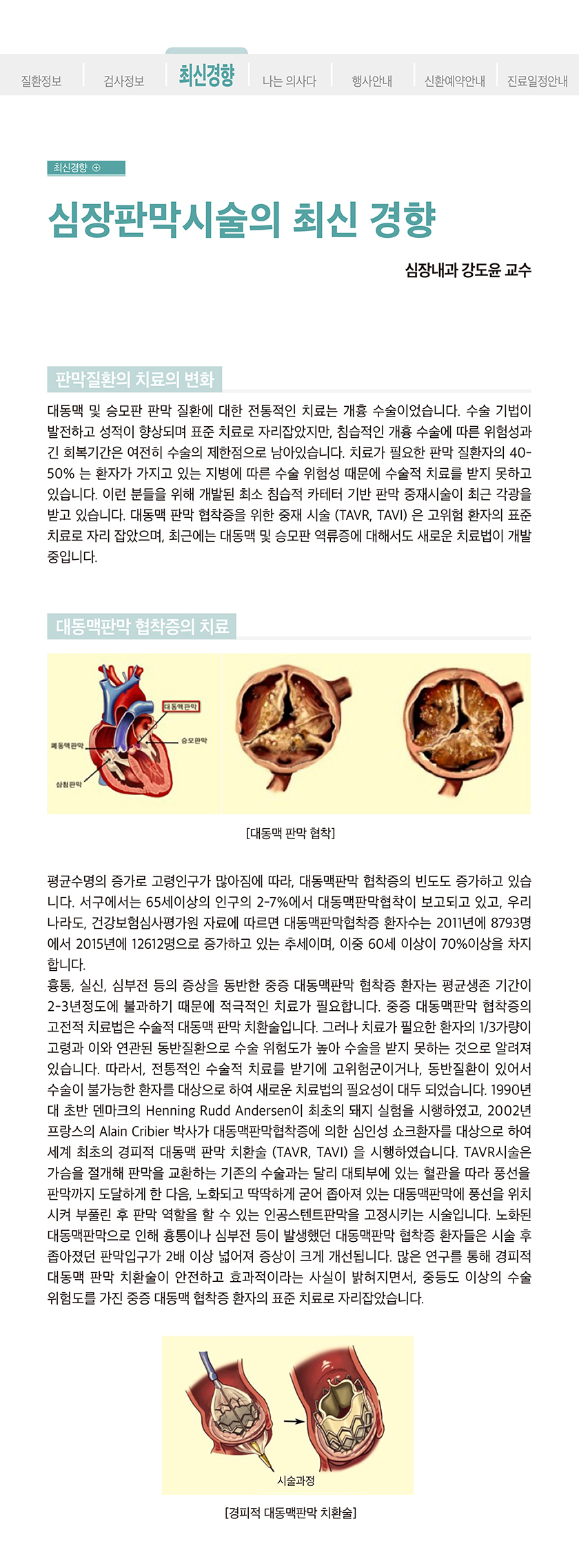 아산심장소식지 2018년 가을호 심장판막시술의 최신경향 아산심장소식지 일반인정보 심장병원 서울아산병원