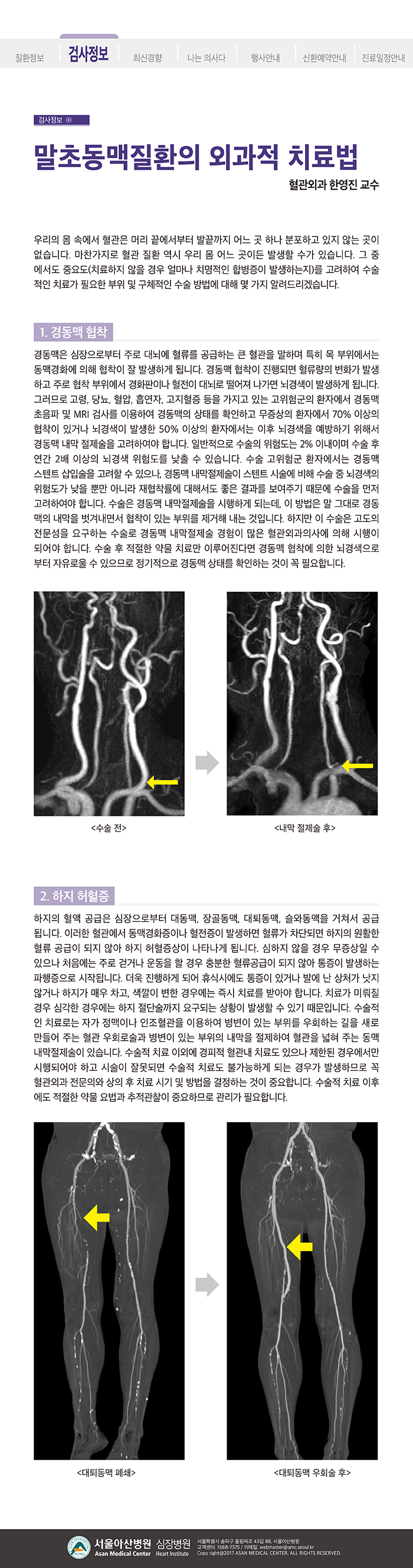 아산심장소식지 2018년 여름호 말초동맥질환의 외과적 수술법 아산심장소식지 일반인정보 심장병원 서울아산병원