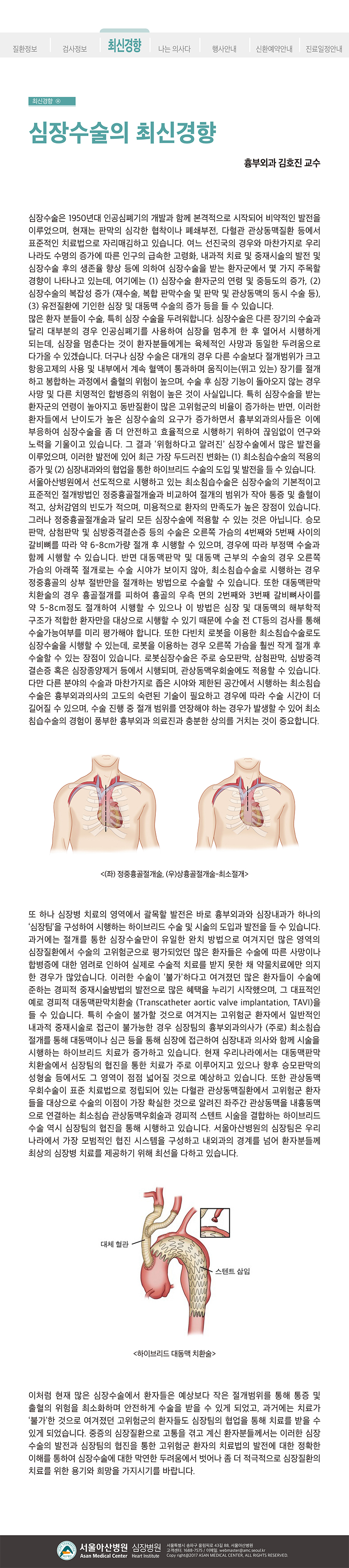 아산심장소식지 2018년 겨울호 심장수술의 최신경향 아산심장소식지 일반인정보 심장병원 서울아산병원
