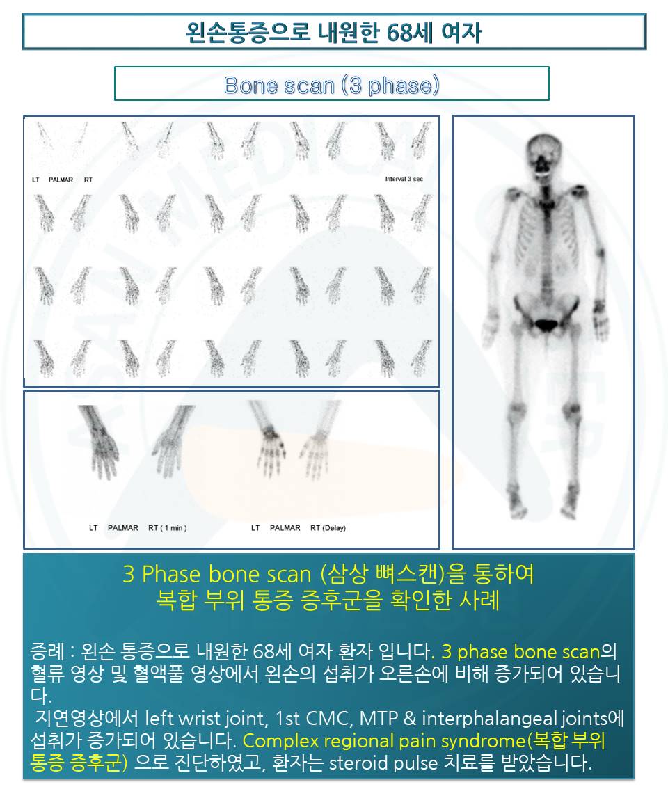 [Three phase bone scan] 왼손통증으로 내원한 68세 여자 | 핵의학 증례 영상 | 자료실 | 핵의학과 | 서울아산병원