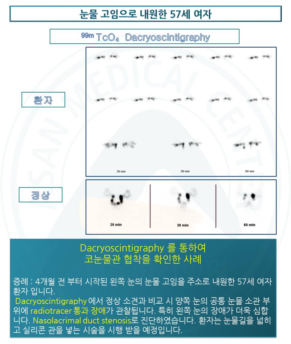 [Dacryoscintigraphy] 눈물고임으로 내원한 57세 여자 | 핵의학 증례 영상 | 자료실 | 핵의학과 | 서울아산병원