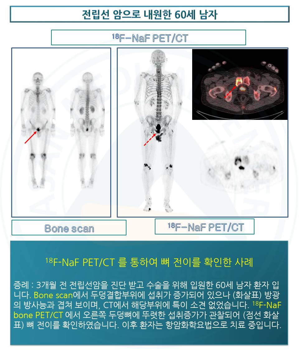 [Whole body PET/CT(F-18 NAF)] 전립선 암으로 내원한 60세 남자 | 핵의학 증례 영상 | 자료실 ...