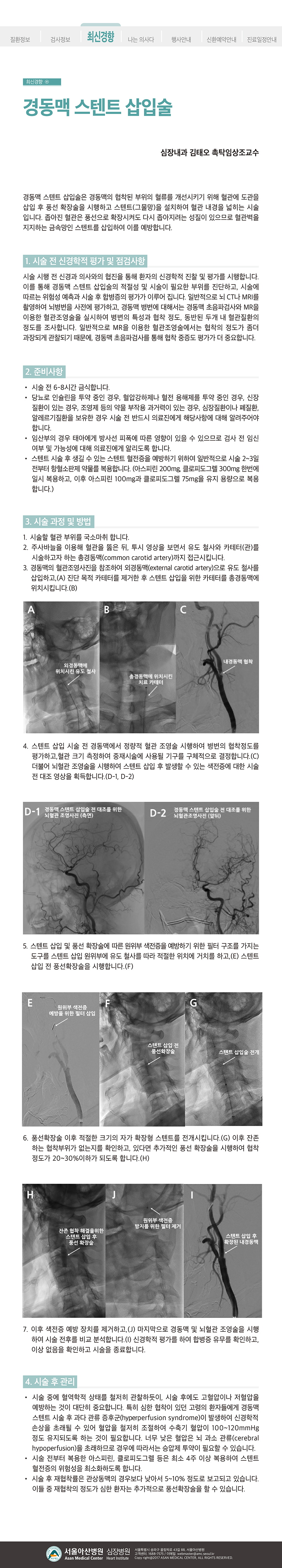 아산심장소식지 2021년 여름호 경동맥 스텐트 삽입술 아산심장소식지 일반인정보 심장병원 서울아산병원