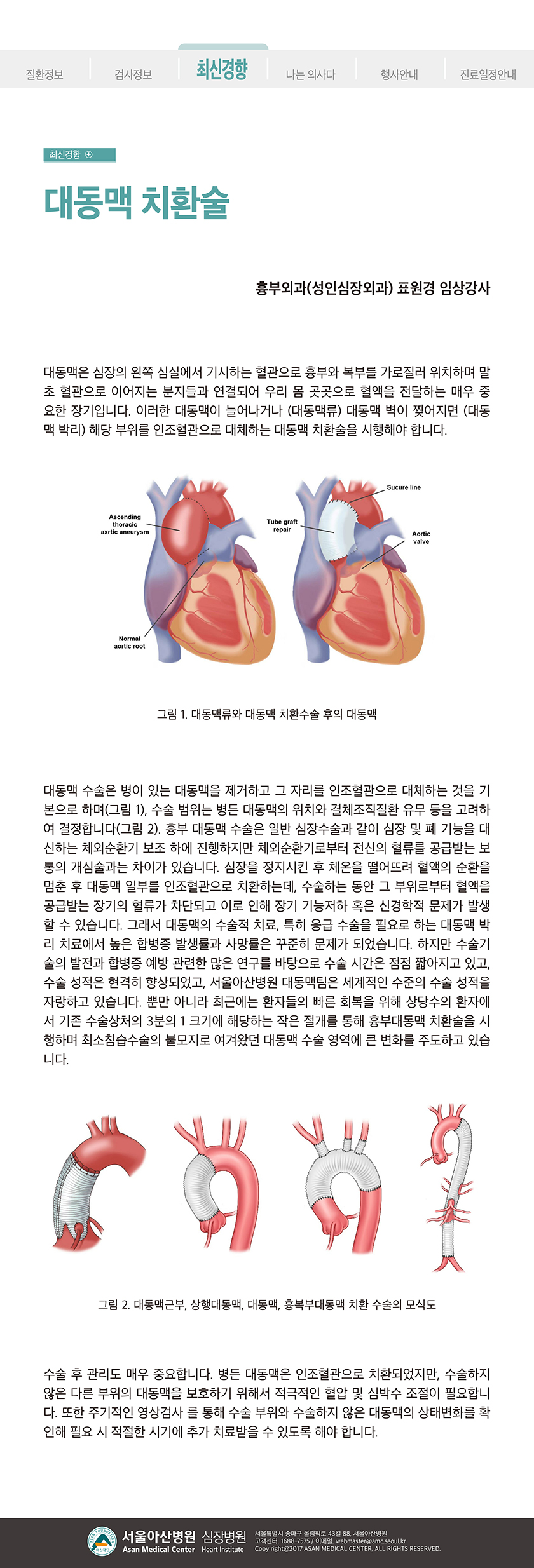 아산심장소식지 2021년 겨울호 대동맥 치환술 아산심장소식지 일반인정보 심장병원 서울아산병원