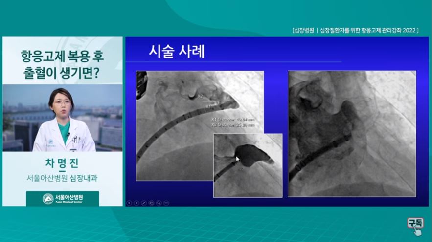 온라인 건강강좌 심장질환자를 위한 항응고제 관리강좌 2022 항응고제 복용 후 출혈이 생기면 새소식·공지 일반인