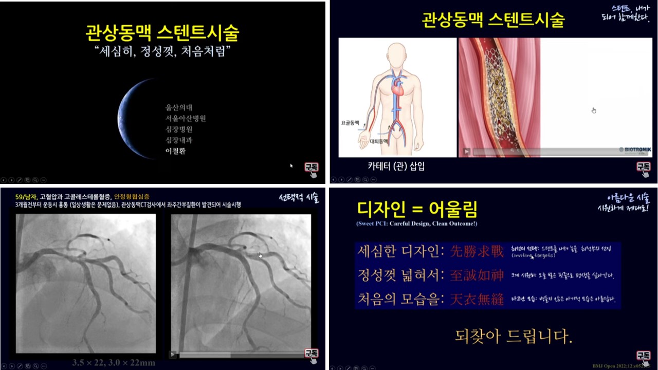 온라인 건강강좌 관상동맥 스텐트시술 세심히 정성껏 처음처럼 새소식·공지 일반인정보 심장병원 서울아산병원